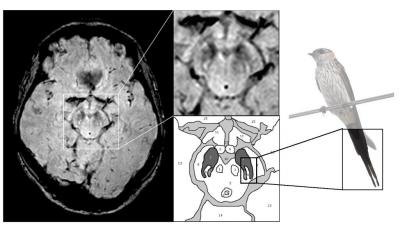 'Tell-tail' MRI image diagnosis for Parkinson | EurekAlert!