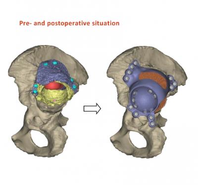 Pre and Post Op Hip [IMAGE] | EurekAlert! Science News Releases