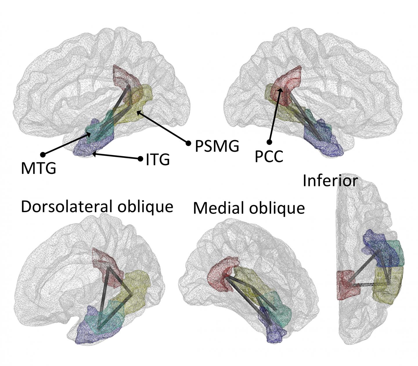 White matter connectome with cortical lesion | EurekAlert!