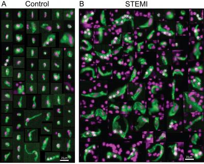 Fast, Accurate Heart-Attack Prediction (2 of | EurekAlert!