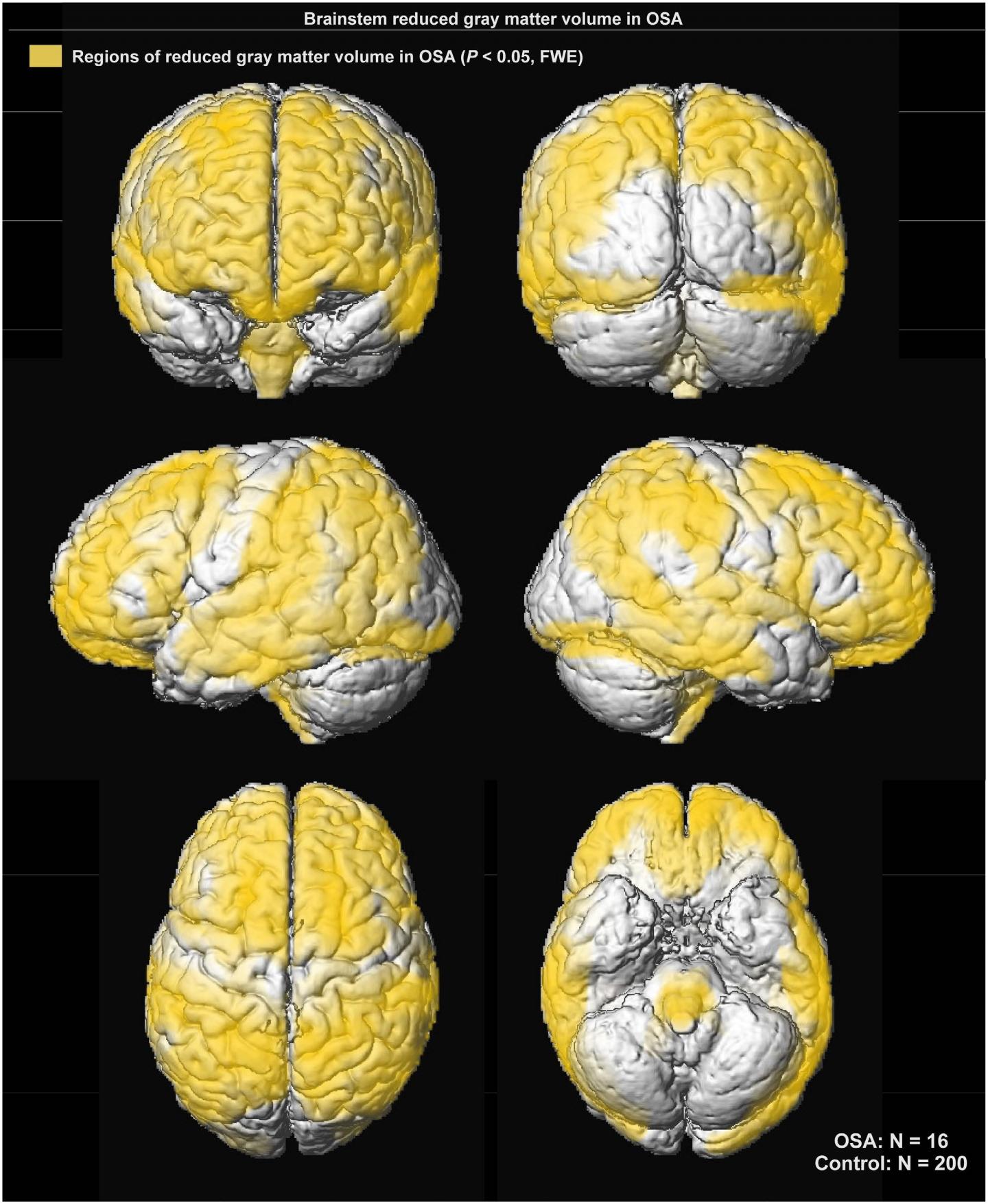 MRI Scans of Gray Matter Volum [IMAGE] | EurekAlert! Science News Releases