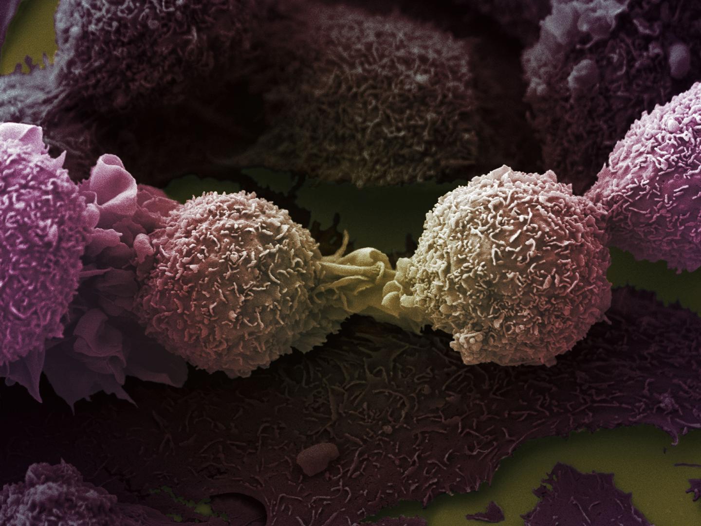 Lung Cancer Cells [IMAGE] | EurekAlert! Science News Releases