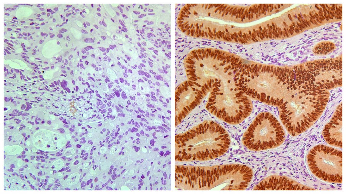 Stage II Colon Cancer [IMAGE] | EurekAlert! Science News Releases