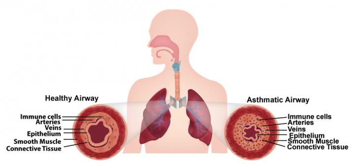 Airway muscle-on-a-chip mimics asthma | EurekAlert!