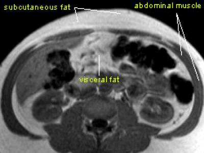Belly fat may drive inflammatory processes as | EurekAlert!