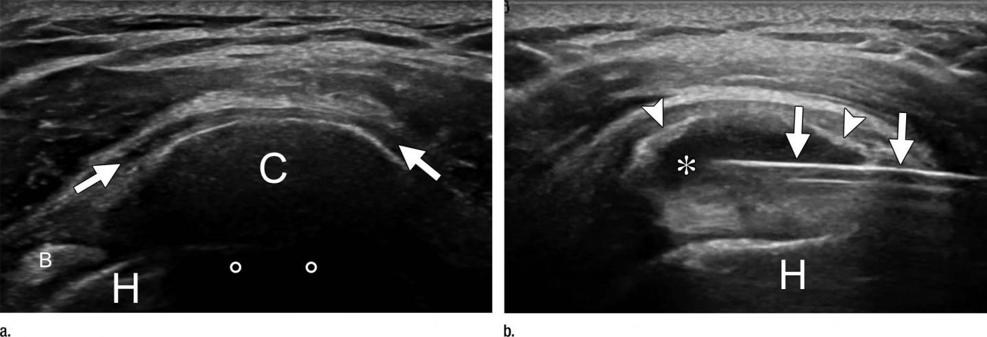 Supraspinatus Calcification [IMAGE] | EurekAlert! Science News Releases