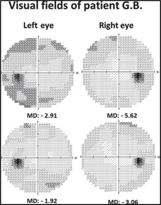 Visual fields of patient G.B. [IMAGE] | EurekAlert! Science News Releases