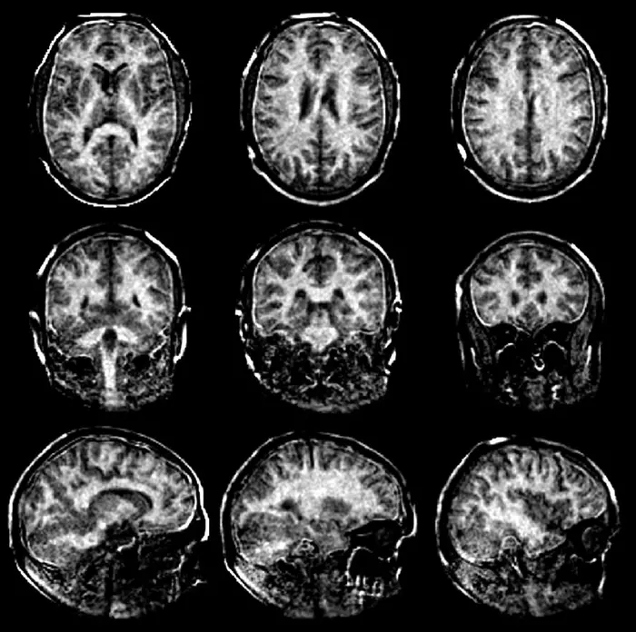 Visualising multiple sclerosis with a new MRI | EurekAlert!