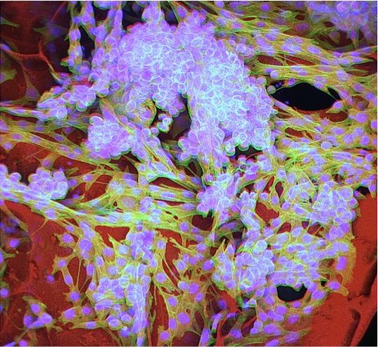 Cancer Cells Embedded in Cryog [IMAGE] | EurekAlert! Science News Releases