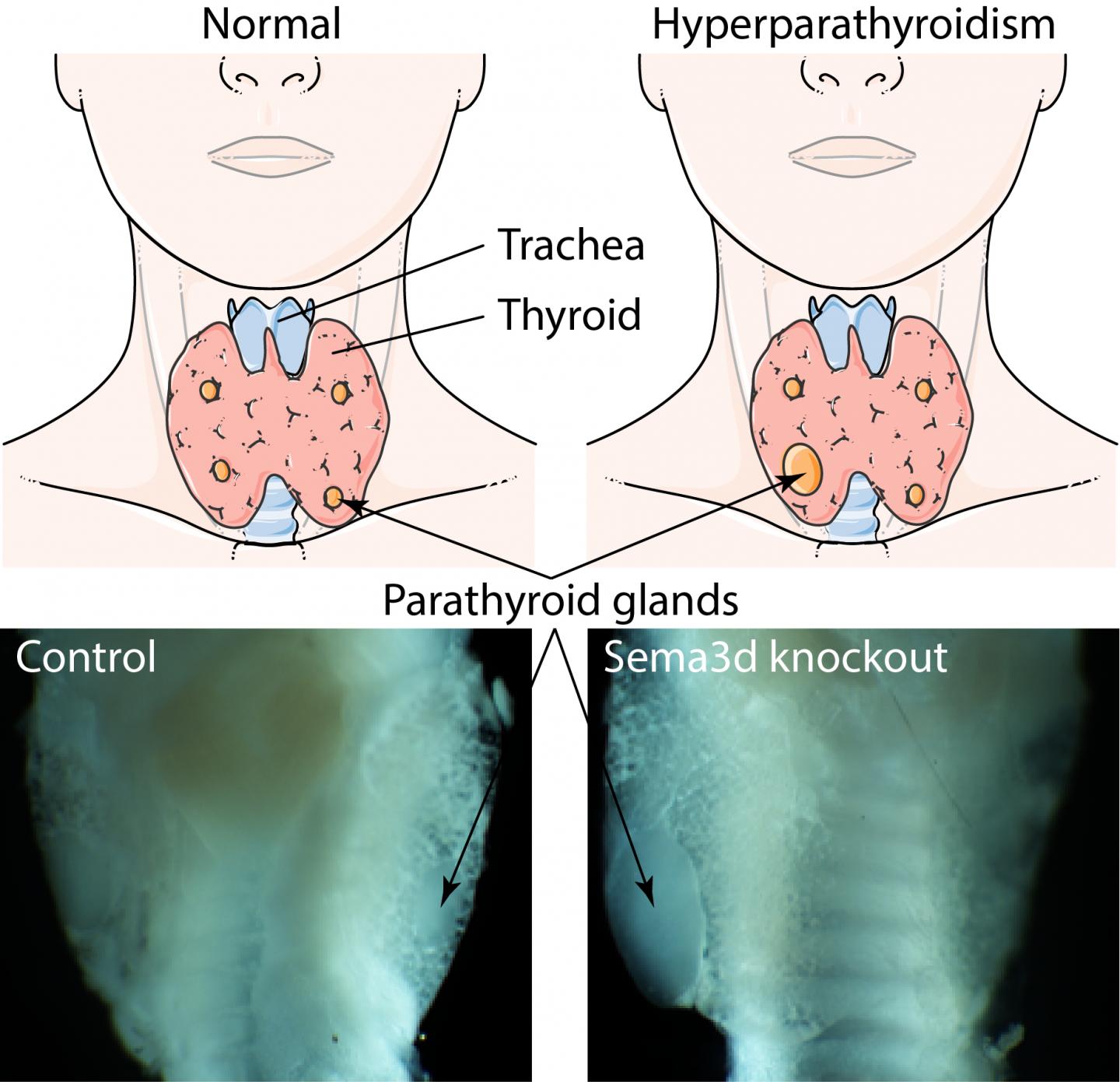Hyperparathyroidism Patient