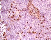 Drug Coaxes Colon Cancer Cells to Death (2 of | EurekAlert!