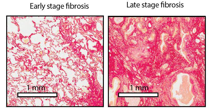 A New Imaging Tool Can Detect and Monitor Lun | EurekAlert!