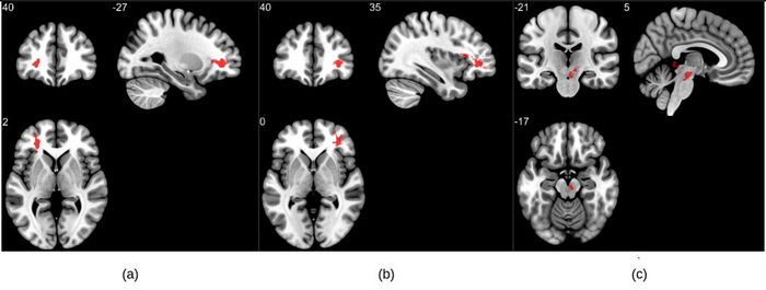 MRI reveals significant brain abnormalities p | EurekAlert!