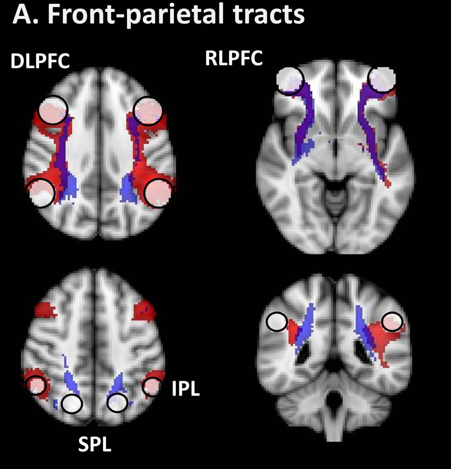 Fronto-Parietal Structural Con [IMAGE] | EurekAlert! Science News Releases