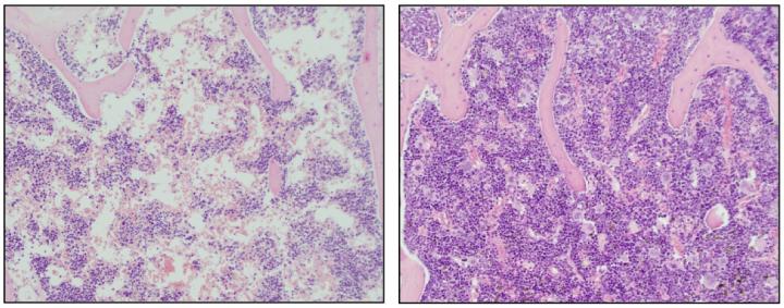 Aplastic Anemia [IMAGE] | EurekAlert! Science News Releases