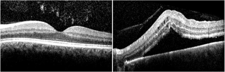 Human Normal vs. RD OCT [IMAGE] | EurekAlert! Science News Releases