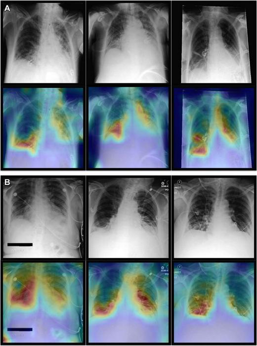 AI combines chest X-rays with patient data to | EurekAlert!