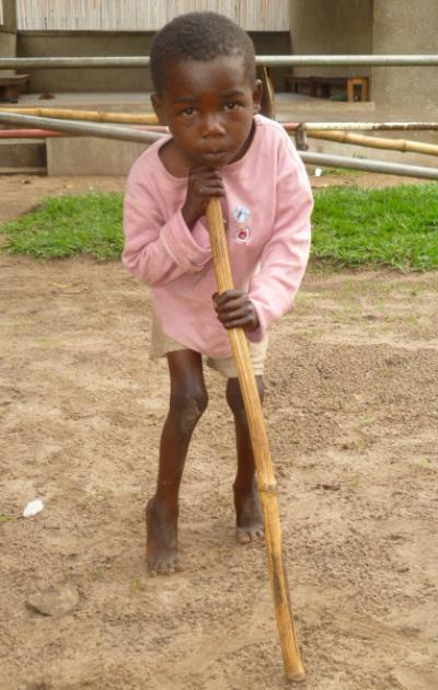 Child with Konzo [IMAGE] | EurekAlert! Science News Releases