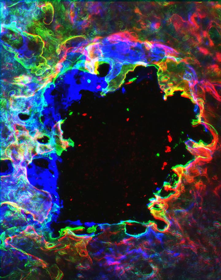 New Clarity in the Imaging of Bone Tumors (2 | EurekAlert!