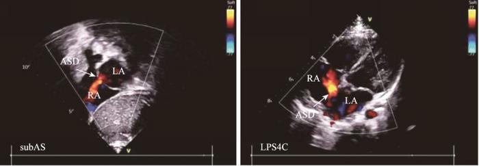 Subcostal view of the atrial s [IMAGE] | EurekAlert! Science News Releases
