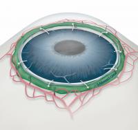 How eyes get clogged in glaucoma and how to f | EurekAlert!