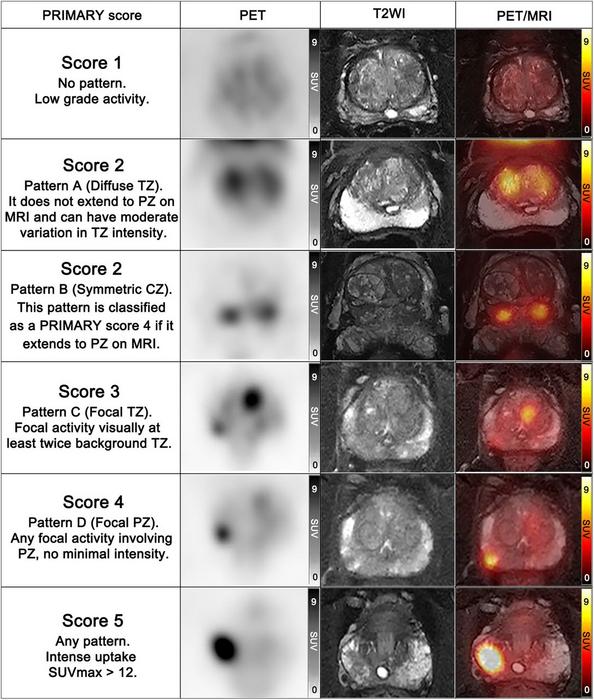 PET/MRI accurately classifies prostate cancer | EurekAlert!
