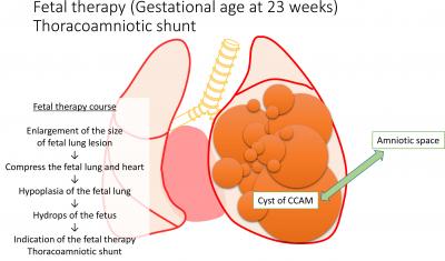 Fetal Therapy [IMAGE] | EurekAlert! Science News Releases