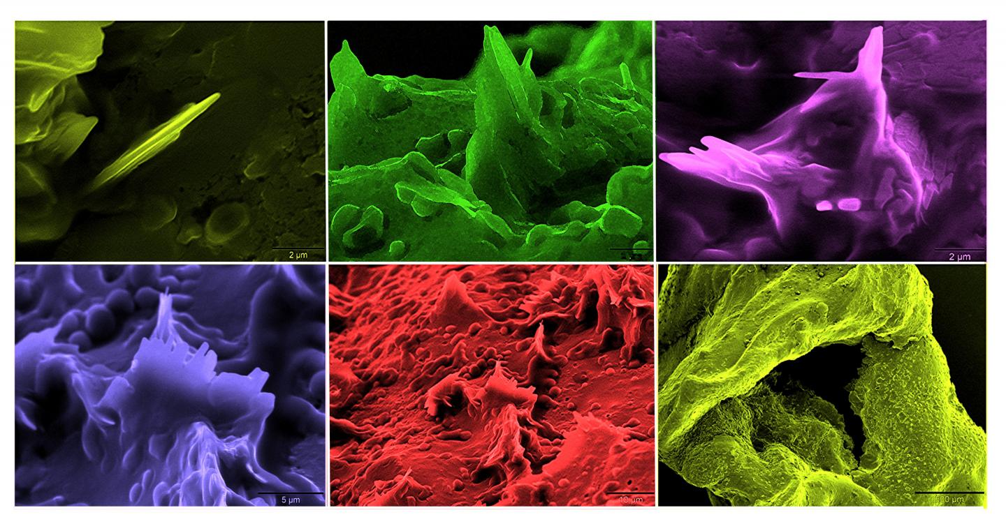 Cholesterol Crystals [IMAGE] | EurekAlert! Science News Releases