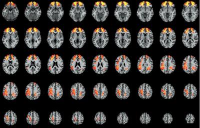Brain Imaging [IMAGE] | EurekAlert! Science News Releases