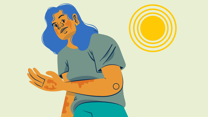 Lupus Graphic [IMAGE] | EurekAlert! Science News Releases