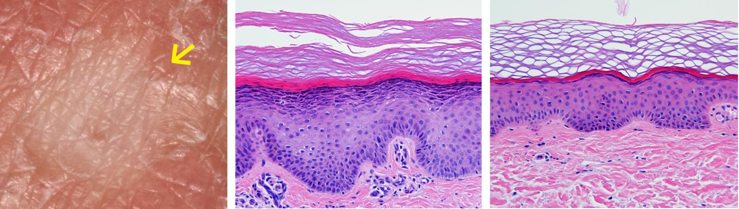 Loricrin Keratoderma Sample [IMAGE] | EurekAlert! Science News Releases