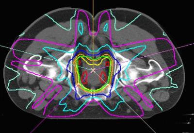 Prostate CT [IMAGE] | EurekAlert! Science News Releases