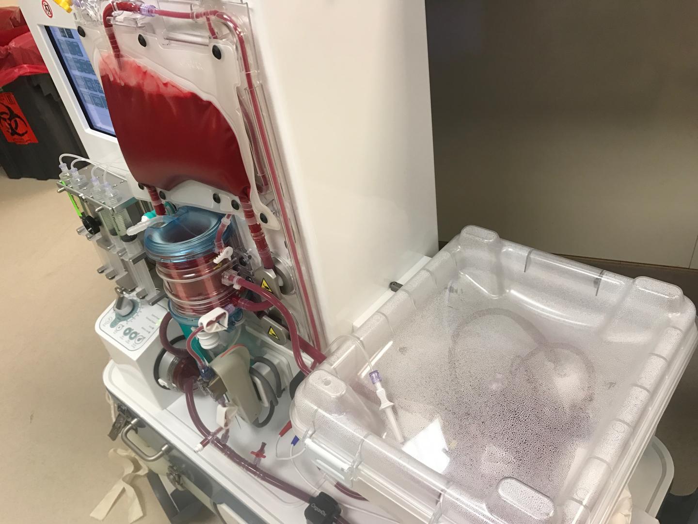 UAB performs Alabama's first transplant where | EurekAlert!