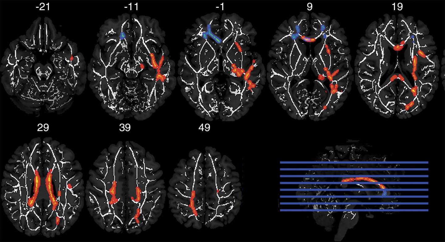 Image 1 Axial MRIs [IMAGE] | EurekAlert! Science News Releases