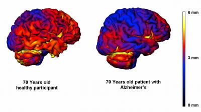 Dementia: Early detection is key | EurekAlert!