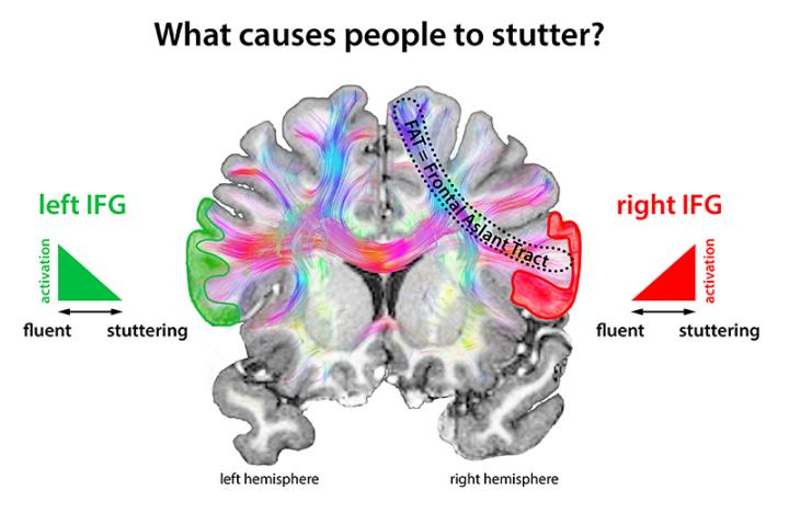 What Causes People to Stutter [IMAGE] | EurekAlert! Science News Releases