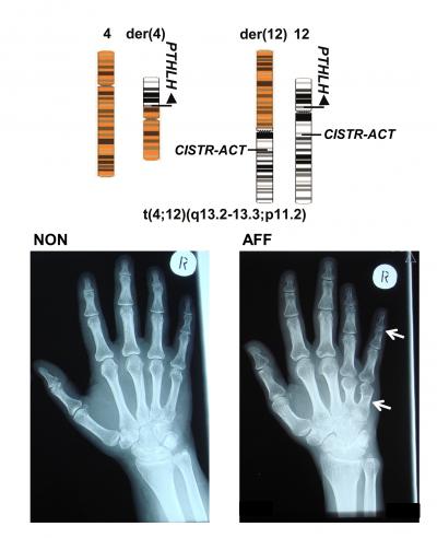 Shortened Fingers [IMAGE] | EurekAlert! Science News Releases