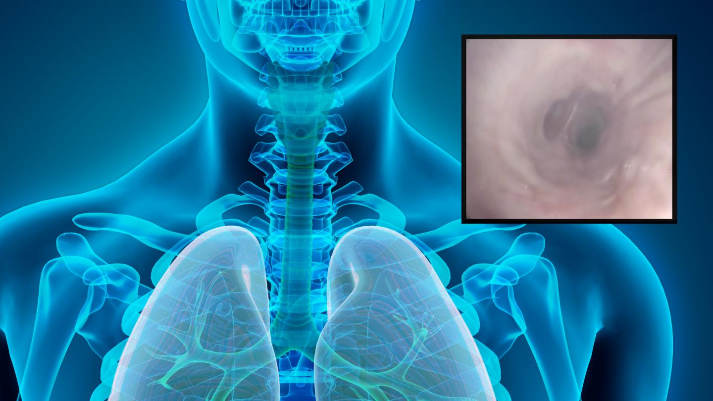 Bronchoscopy [IMAGE] | EurekAlert! Science News Releases