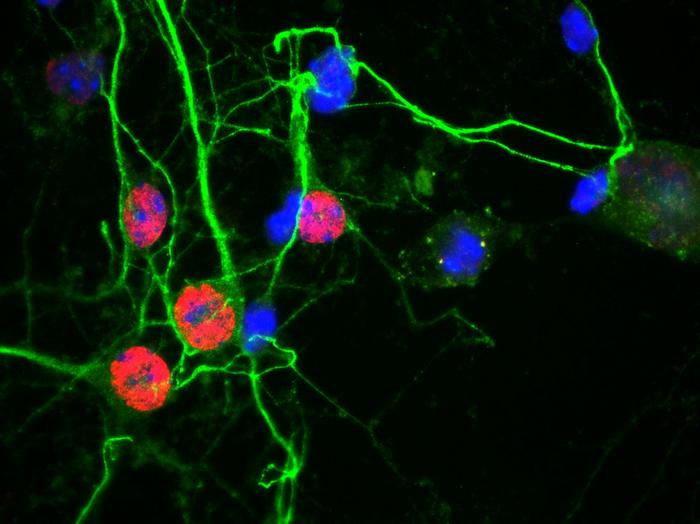 ALS: Newly discovered subtypes and sex differ | EurekAlert!