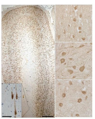 Rare disease in Amish children sheds light on | EurekAlert!