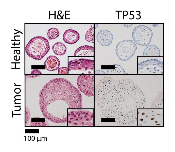 Healthy and Tumor Organoids [IMAGE] | EurekAlert! Science News Releases