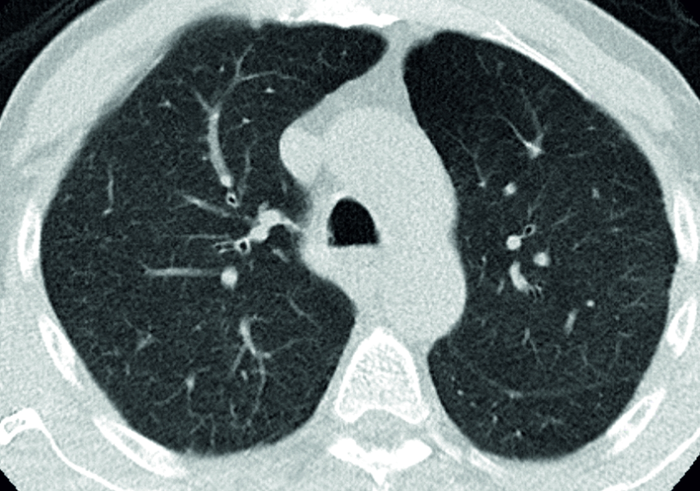 Chest CT showing healthy lungs [IMAGE] | EurekAlert! Science News Releases