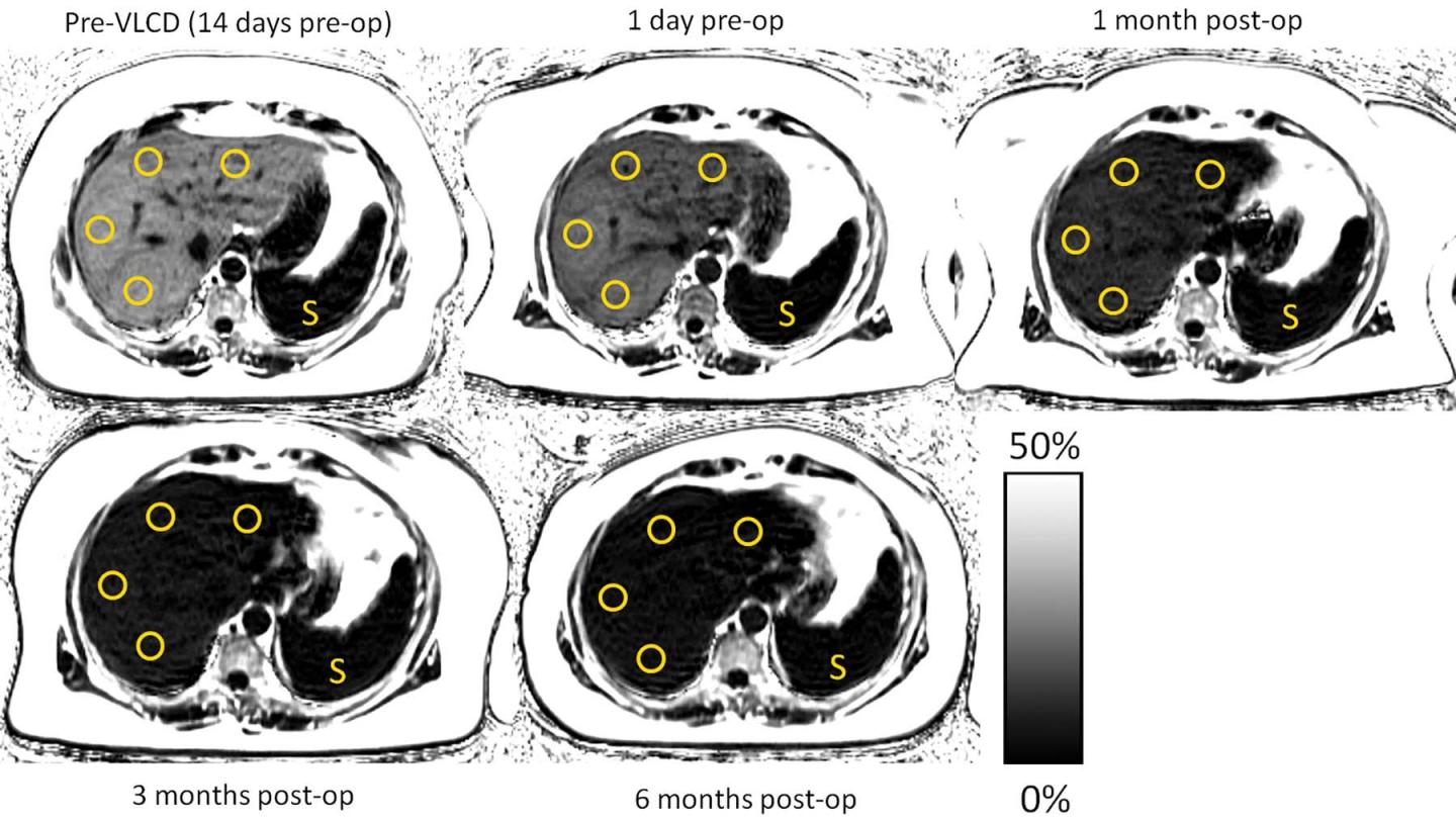 MRI Effective for Monitoring L [IMAGE] | EurekAlert! Science News Releases