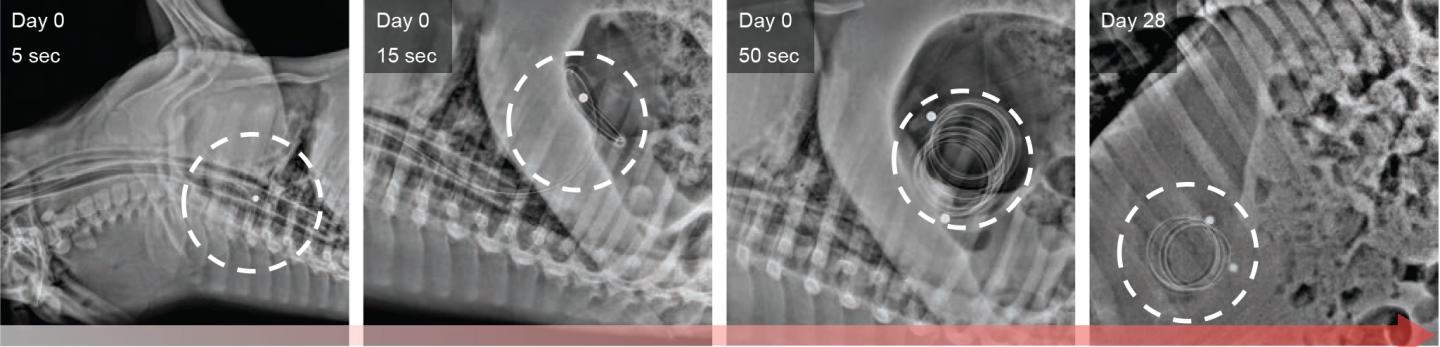 Drug-Delivering Device Streamlines Tuberculos | EurekAlert!