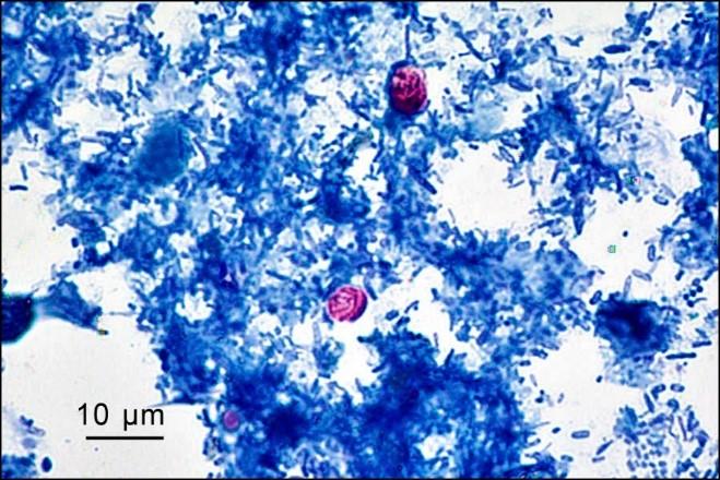 A 'tropical' parasitic disease emerges in the | EurekAlert!