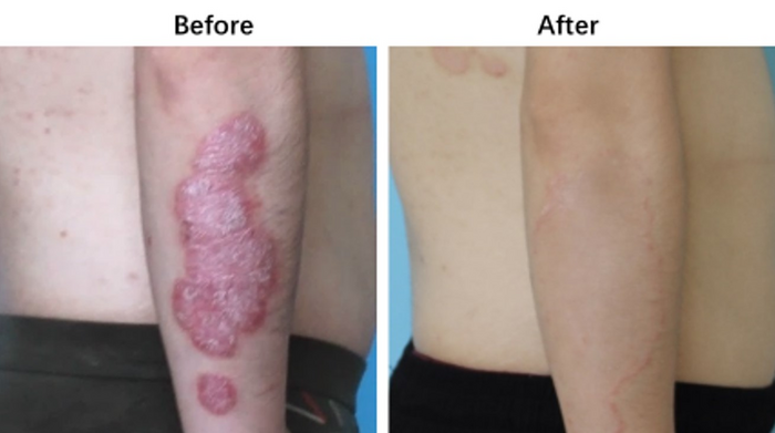 Epidural nerve block with lidocaine leads to | EurekAlert!