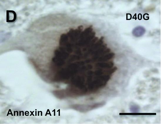 A Link Between Newly Identified Rare Mutation | EurekAlert!