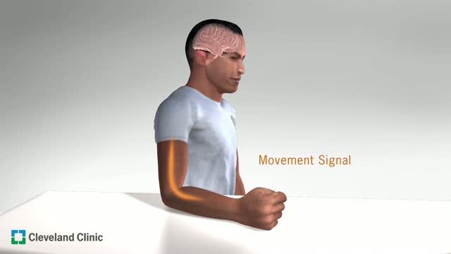 Muscle Vibrations Improve Control Over Prosth | EurekAlert!