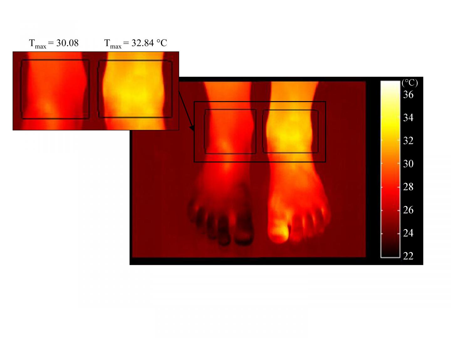 Infrared thermography can detect joint inflam | EurekAlert!