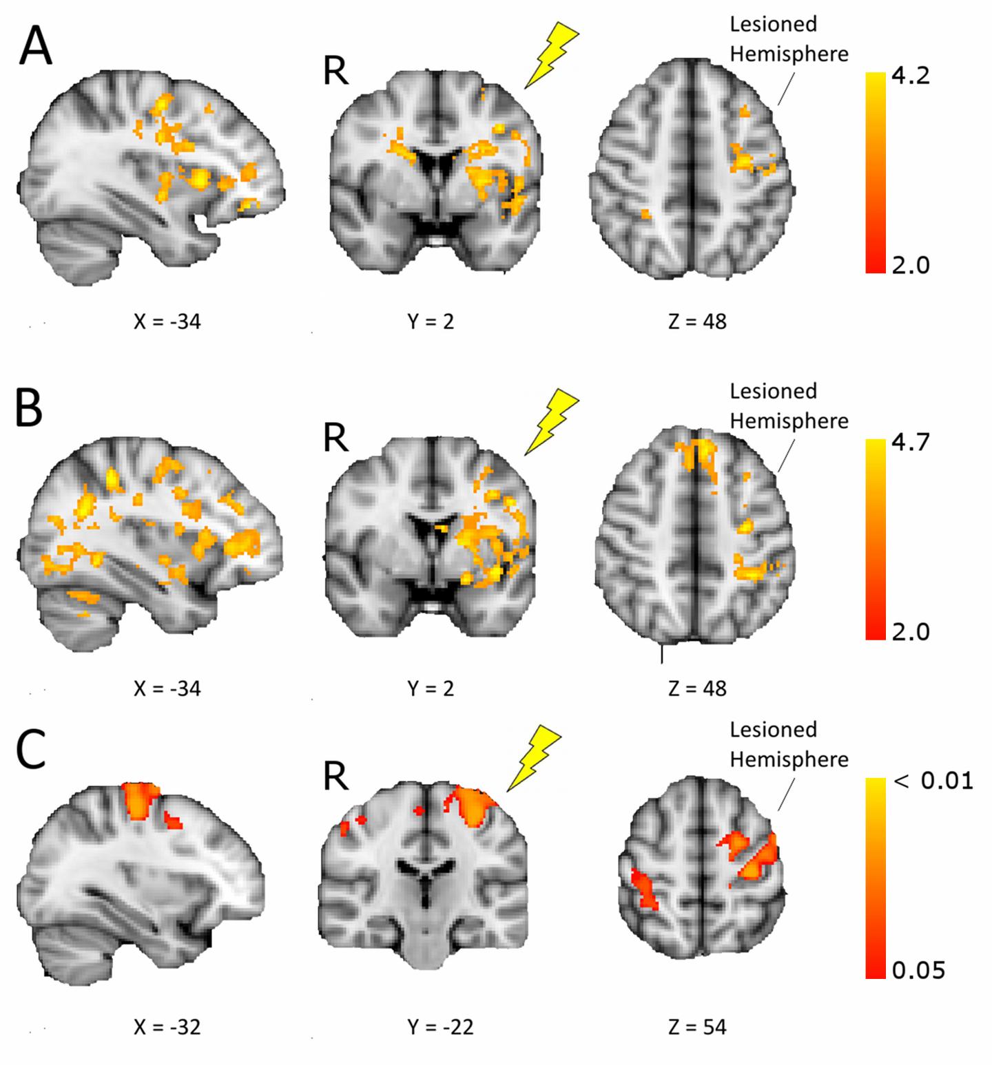 Brain Stimulation Boosts Motor Recovery in St | EurekAlert!